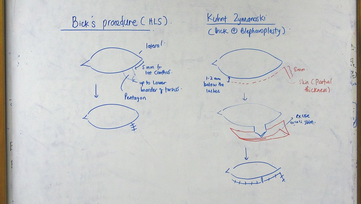 UKM Ophthal Part 2 2010: Ectropion