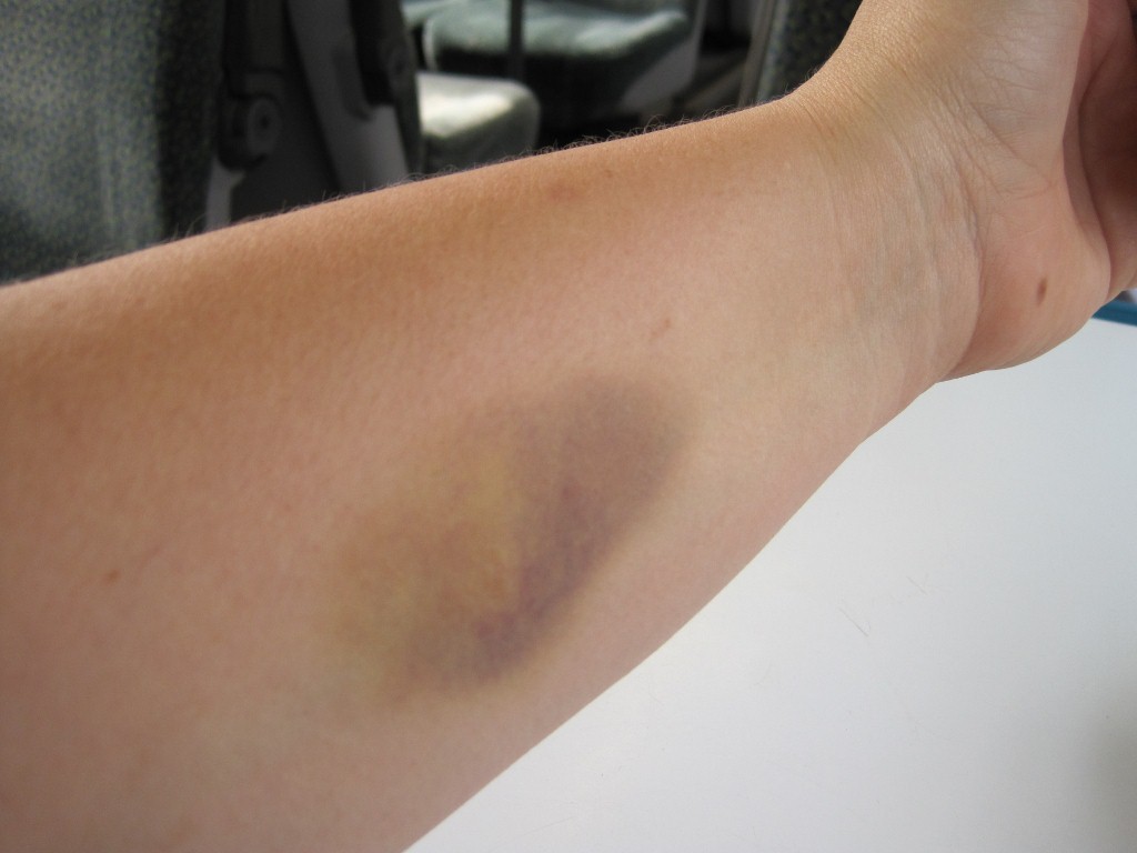 This Transplanted Life: Ghost Bite