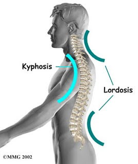 Fajas Firm Internacional: Que es Lordosis?