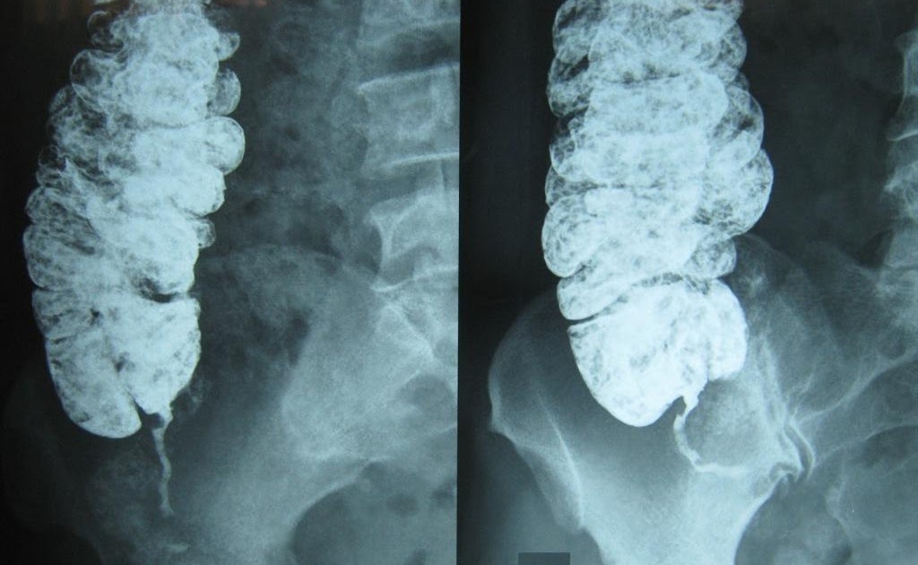 BLOG HIDUP SEHAT: Appendicogram