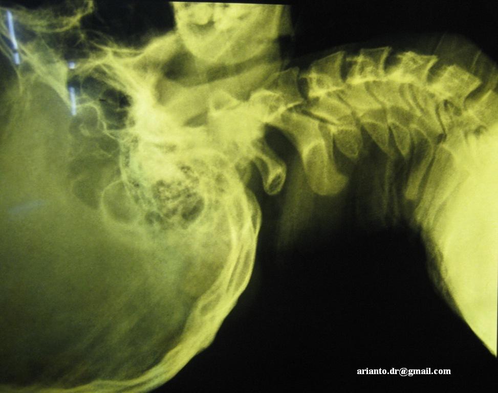 BLOG HIDUP SEHAT: Ro Cervical Lateral