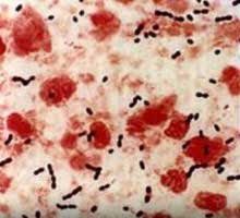 Epidemiologia Escobar: ENFERMEDADES A NEUMOCOCO - Epidemiologiaescobar