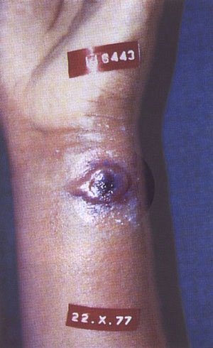 Epidemiologia Escobar: CARBUNCO (ANTRAX) - Lo que debe saber ...