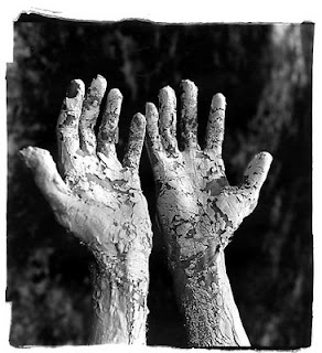 LEPROSY