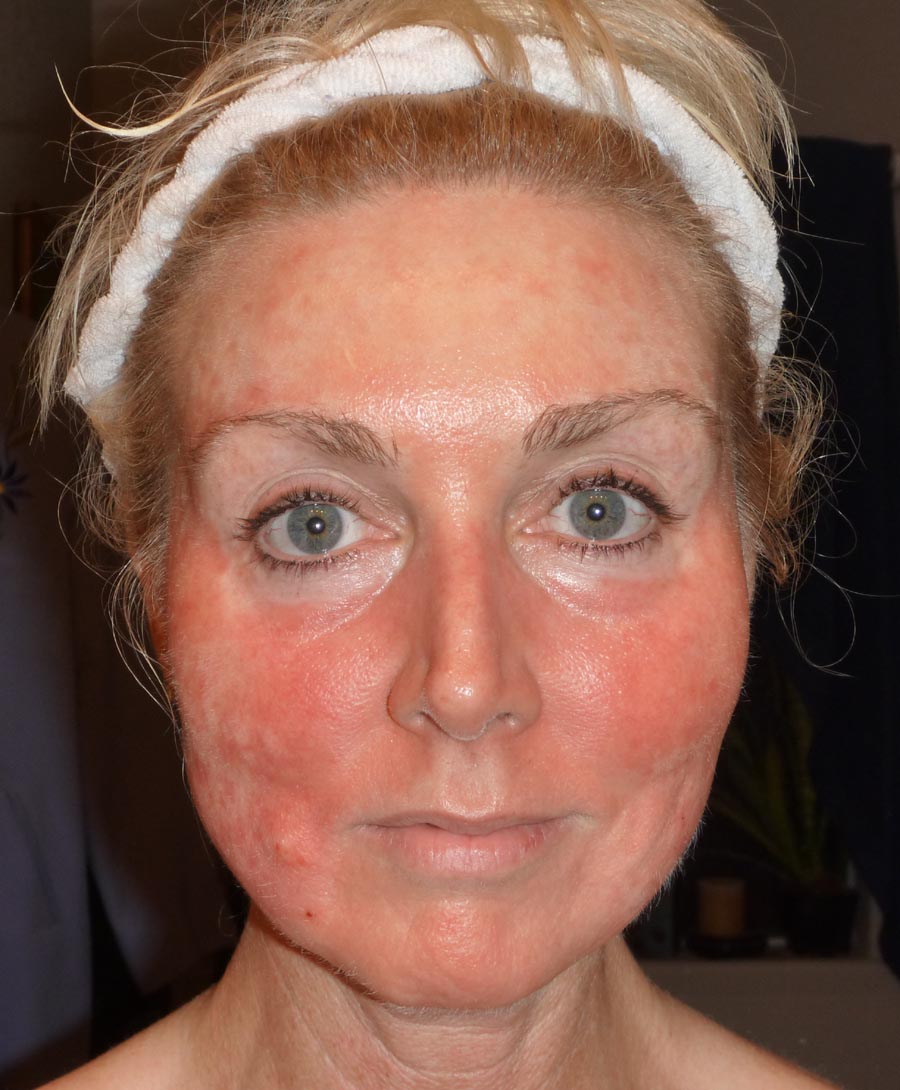 Pam's Efudex Blog: PHOTOS ONLY