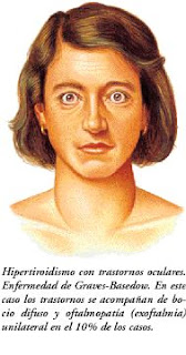 Trabajos de ACT 3º ESO: Bocio