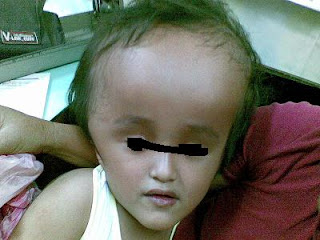 A CASE OF MACROCEPHALY