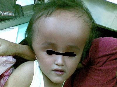 Benign Macrocephaly