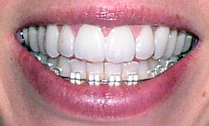 Was OrthoClear, Now Invisalign