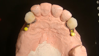 ATACHES ~ Laboratorio de Prótesis Dental Santos