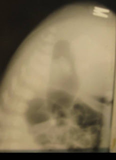 ANORECTAL PEDIATRICA: * Que es el Invertograma