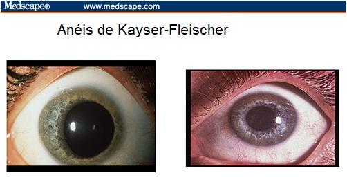 Fisioup: Anéis de Kayser-Fleischer