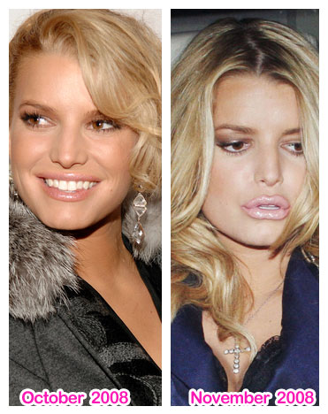 Plastic Surgery Before And After: Jessica Simpson Plastic Surgery