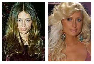 Plastic Surgery Before And After: Paris Hilton Plastic Surgery