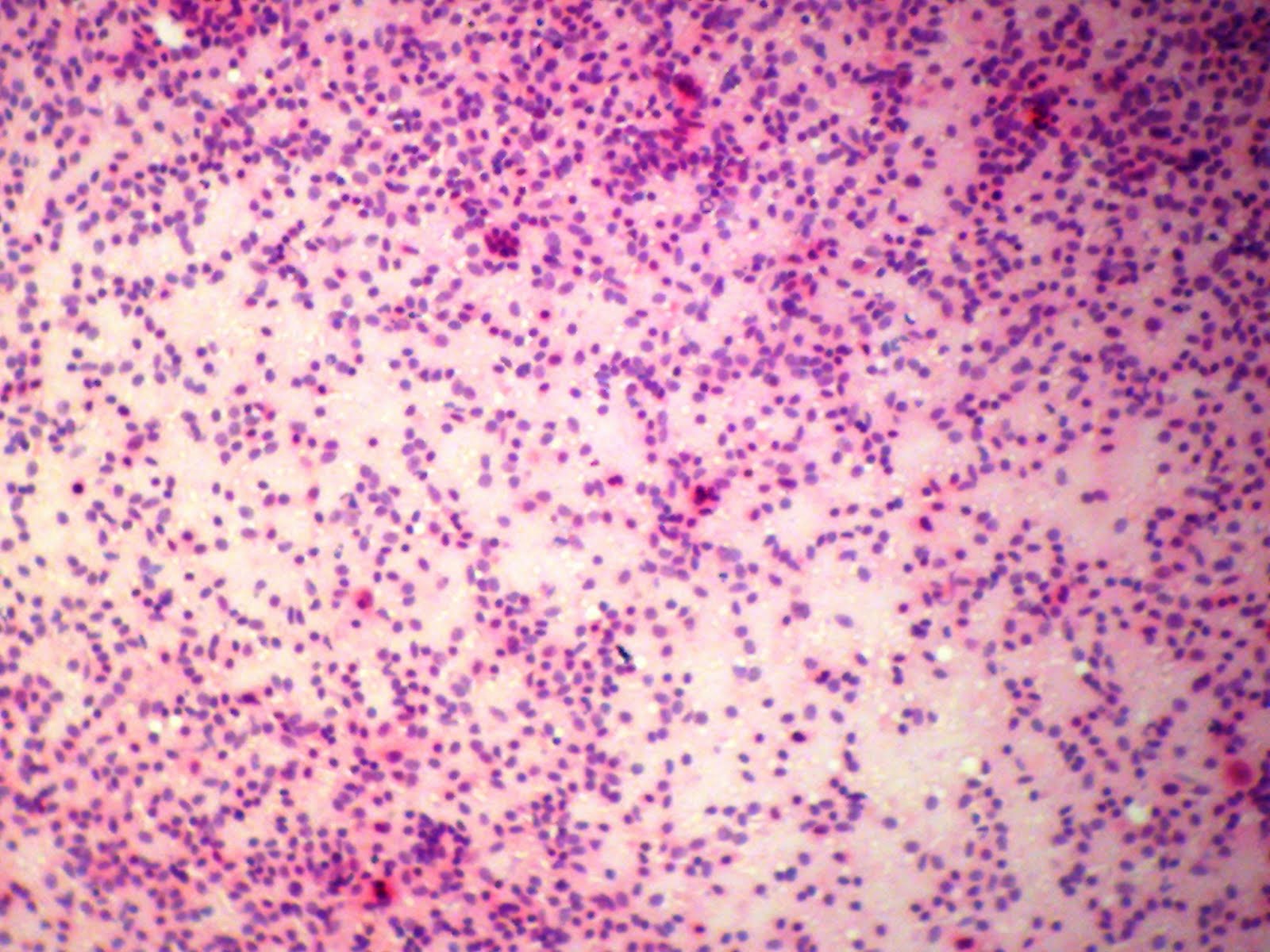 HISTOPATHOLOGY: Retroareolar breast lump