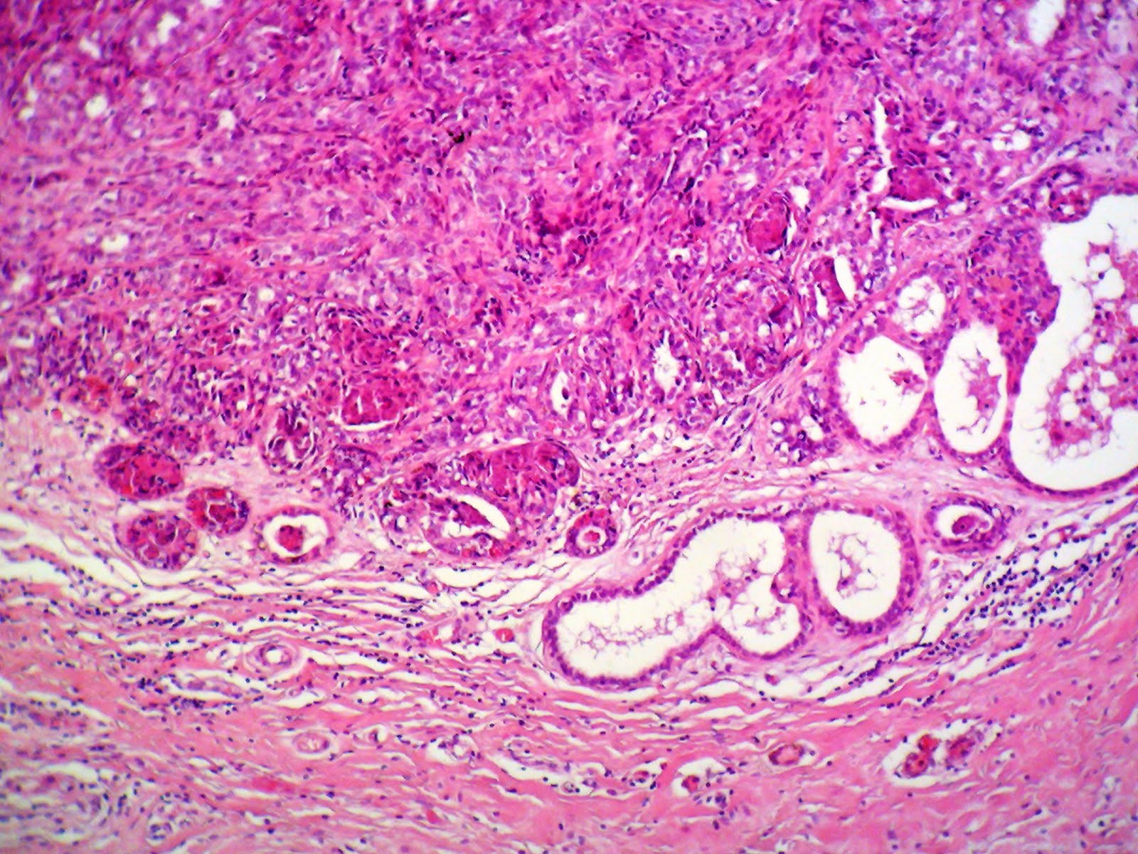 HISTOPATHOLOGY: Retroareolar breast lump