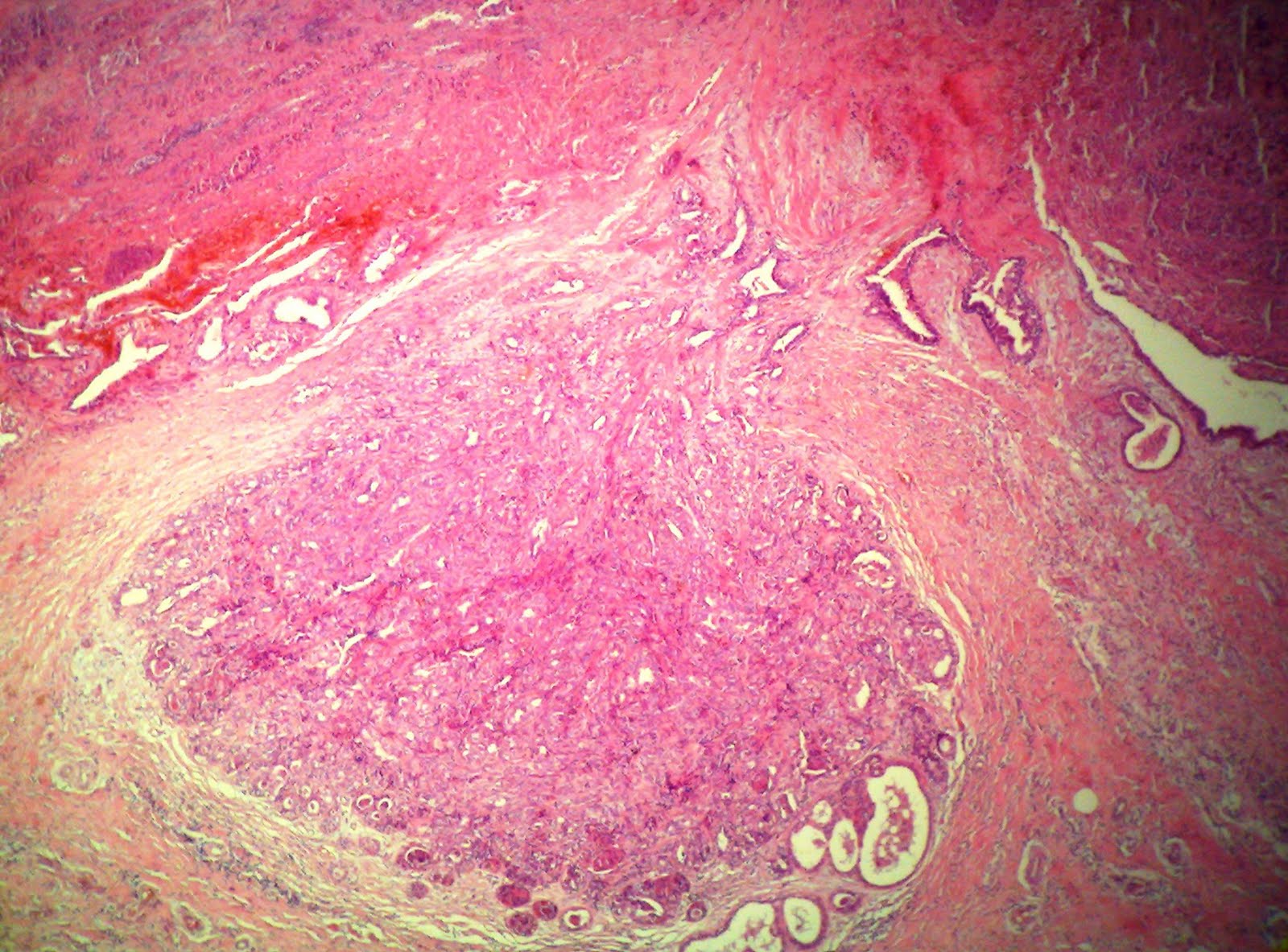HISTOPATHOLOGY: Retroareolar breast lump