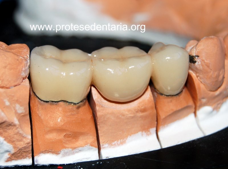 Prótese Dentária em fotos: Próteses Dentárias em Imagens