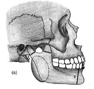 Cirugía Oral y Maxilofacial: Manejo interdisciplinario de tumores en ...