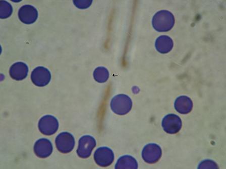 esferocitose constitui uma anomalia em que os eritrócitos se apresentam ...