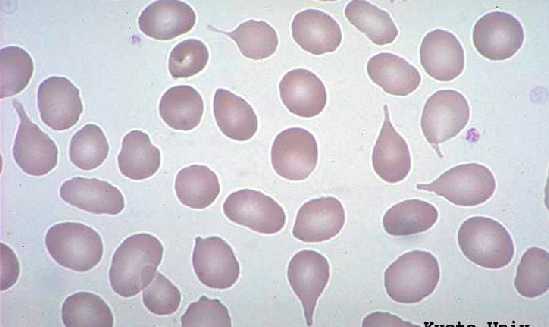 normalmente os eritrócitos apresentam se em forma de discos bicôncavos ...