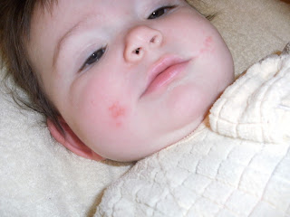 Allergic reaction?? PIP - blisters on face — The Bump