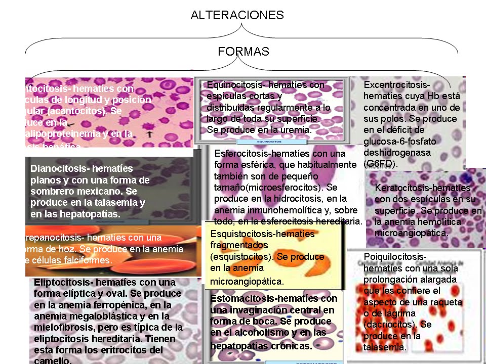 BIOMETRIA HEMATICA: ALTERACIONES DE LOS HEMATIES