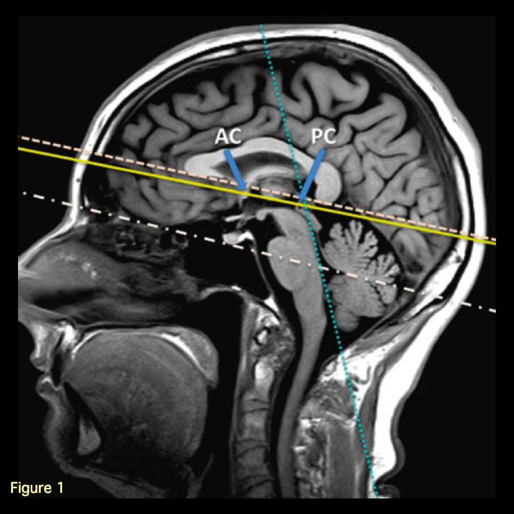 MRI BLOG: Brain MRI (Imaging Planes)