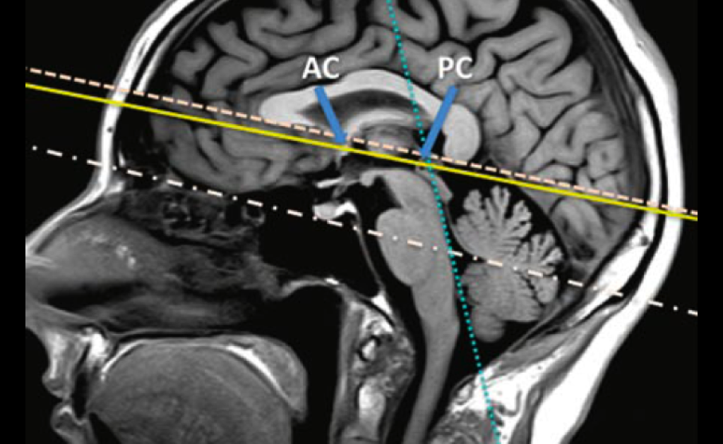 MRI BLOG: Brain MRI (Imaging Planes)