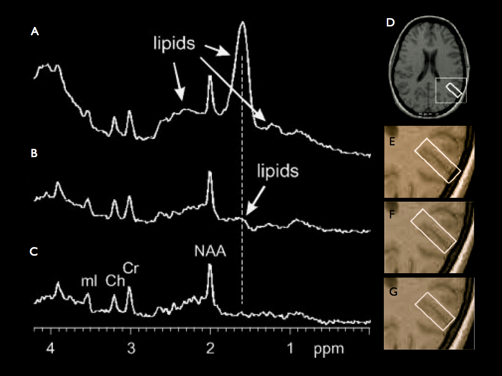 MRI BLOG: Spectral Quality & Artefacts