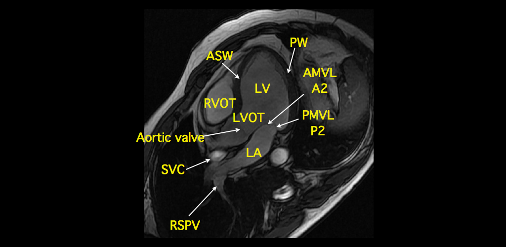 MRI BLOG: Cardiac Anatomy