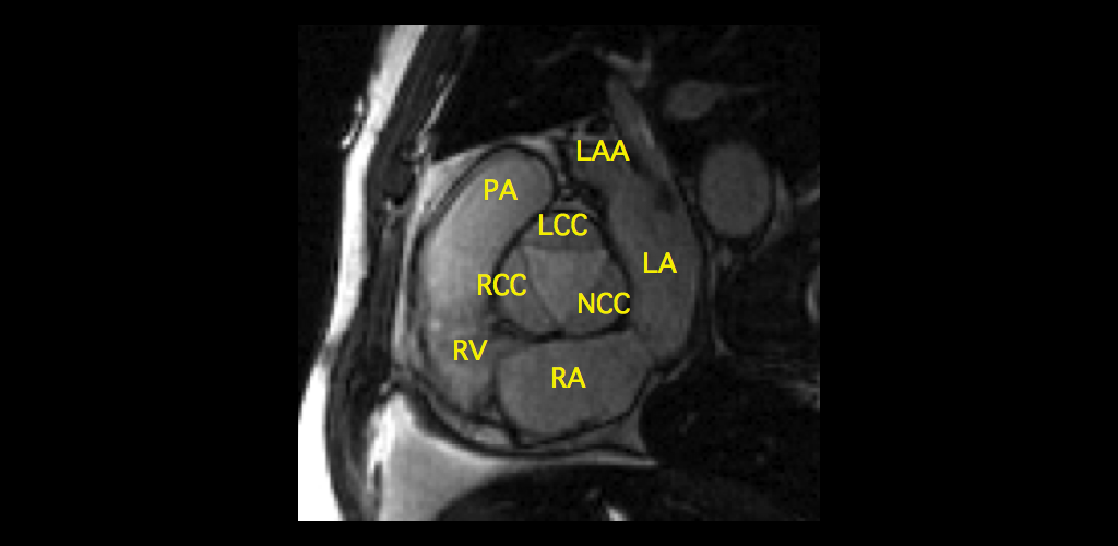 MRI BLOG: Cardiac Anatomy