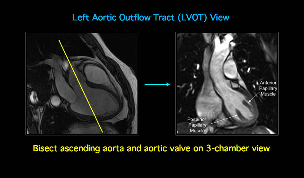 MRI BLOG: Cardiac MRI - Imaging Planes for Basic Cardiac Views