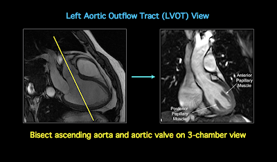 MRI BLOG: Cardiac MRI - Imaging Planes for Basic Cardiac Views