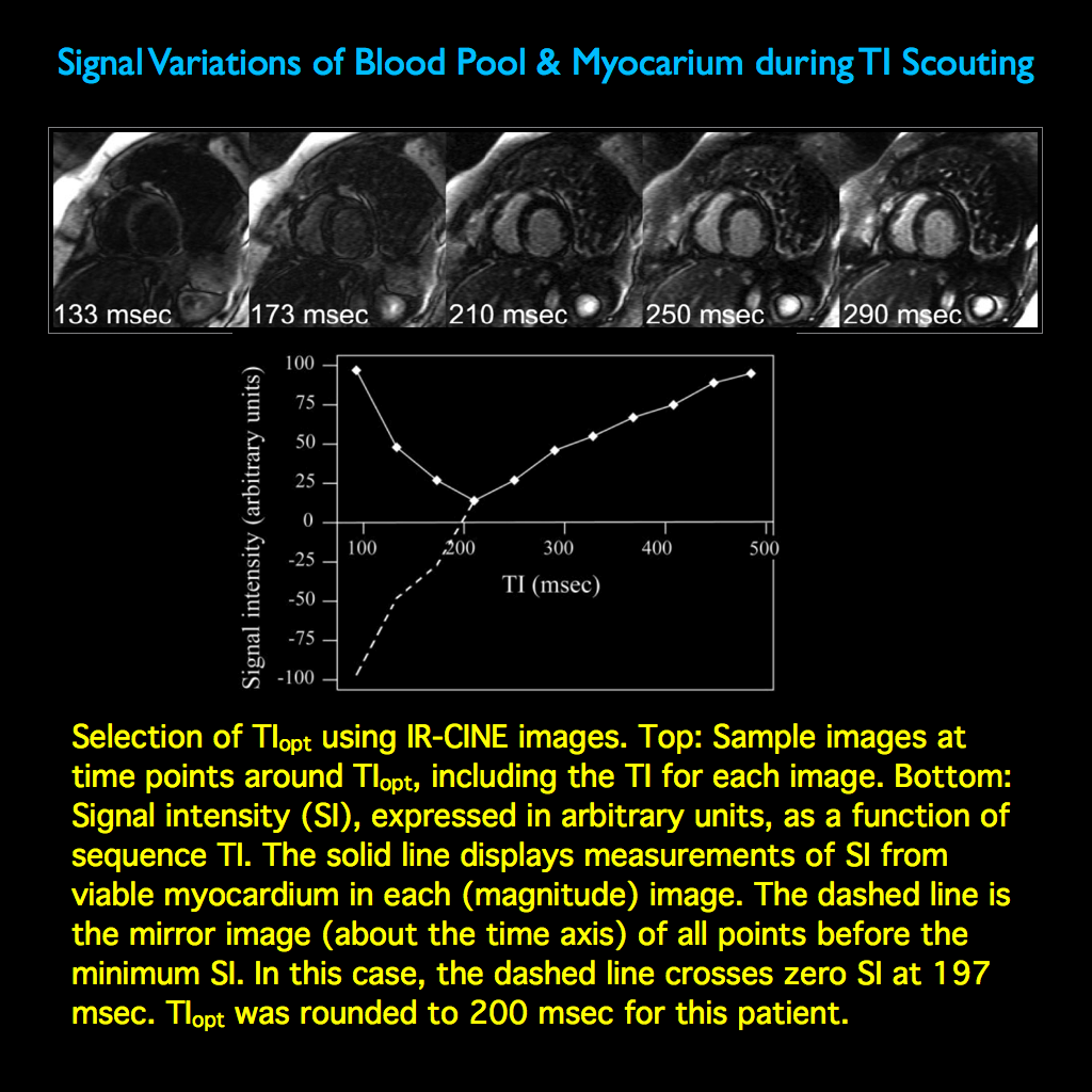 MRI BLOG: Signal Variations in TI Scouting for Late Gd Enhancement (LGE ...