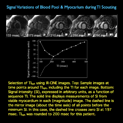 MRI BLOG: Signal Variations in TI Scouting for Late Gd Enhancement (LGE ...