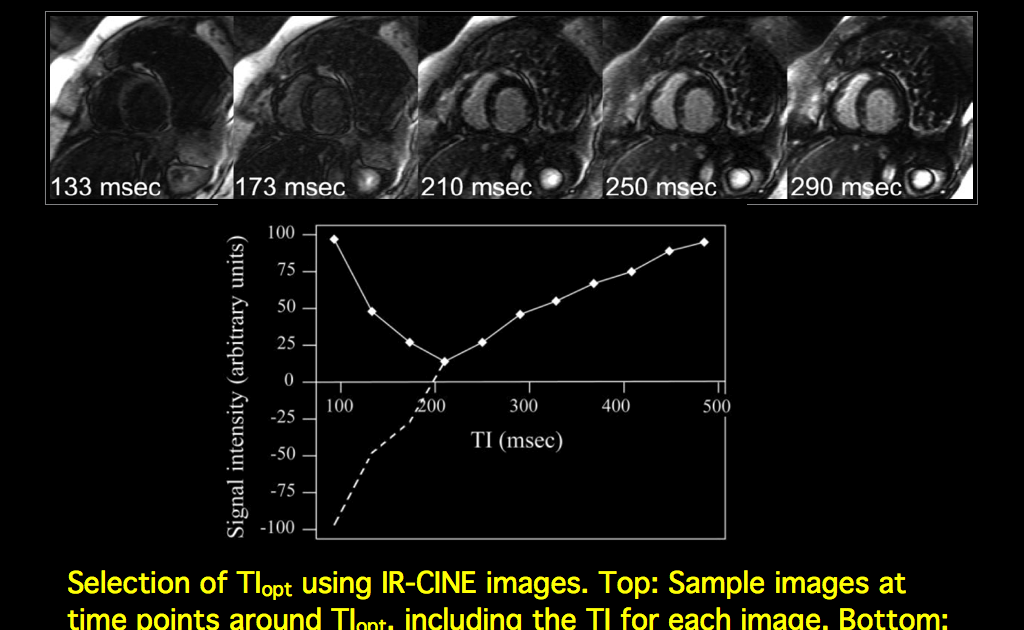 MRI BLOG: Signal Variations in TI Scouting for Late Gd Enhancement (LGE ...