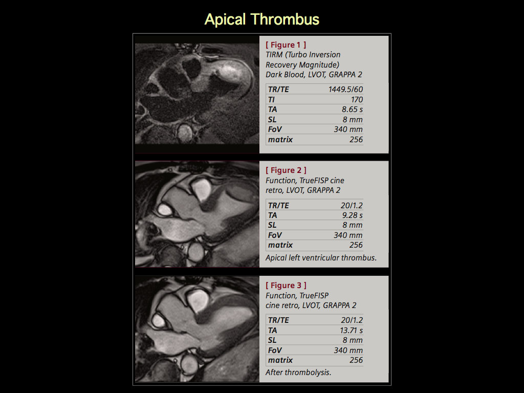 MRI BLOG: Imagery of Cardiac Pathology