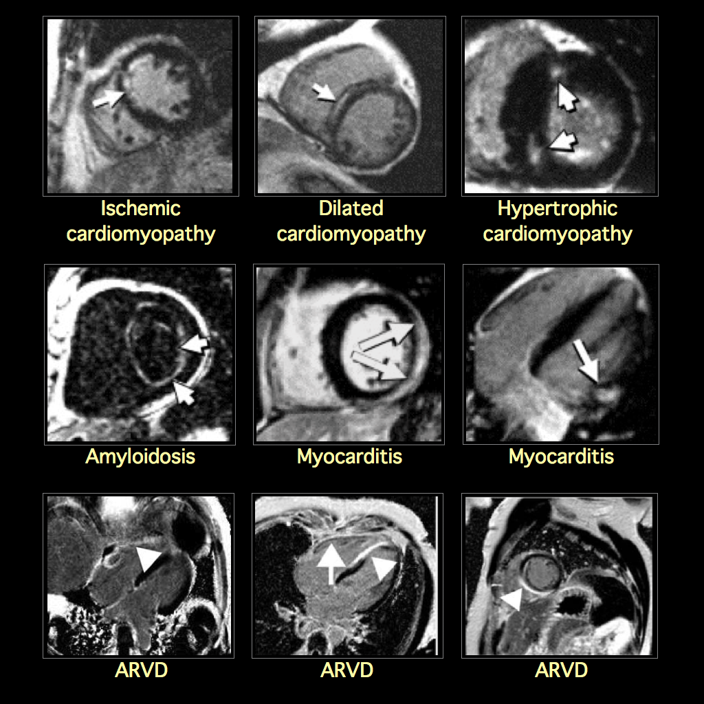 Mri Blog Imagery Of Cardiac Pathology
