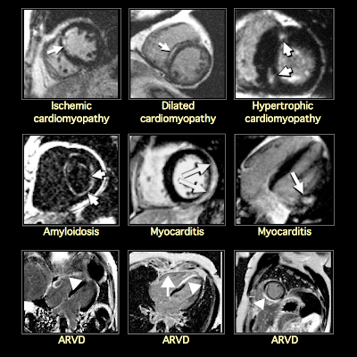 MRI BLOG: Imagery of Cardiac Pathology