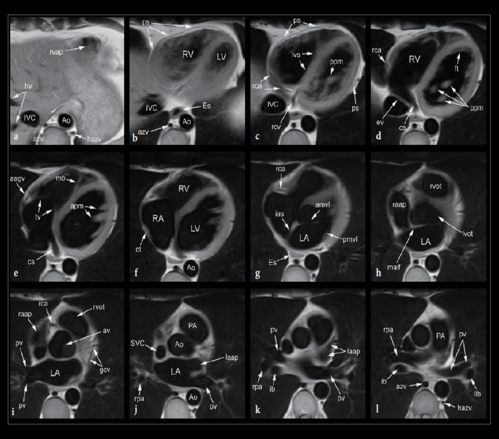 MRI BLOG: Detailed CMR Anatomy