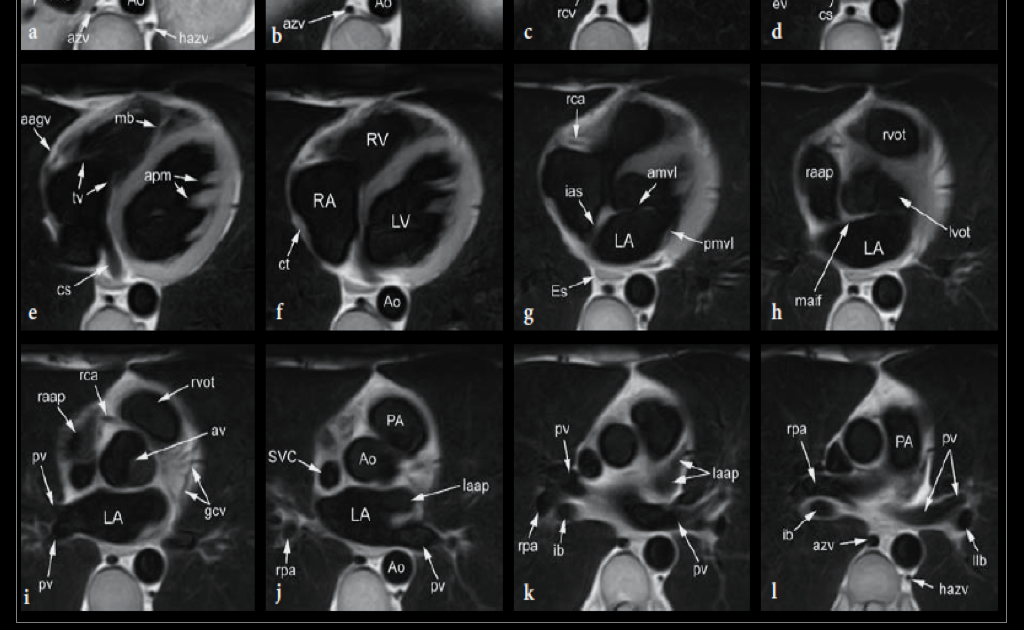 MRI BLOG: Detailed CMR Anatomy