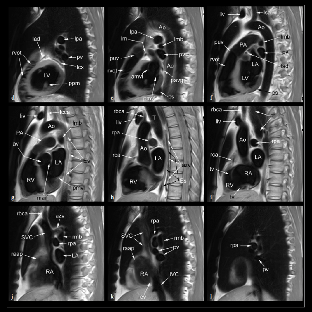 MRI BLOG: Detailed CMR Anatomy