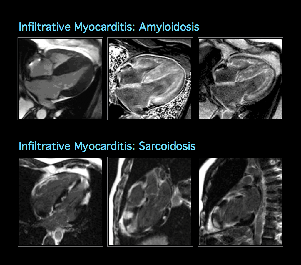 MRI BLOG: Imagery of Cardiac Pathology