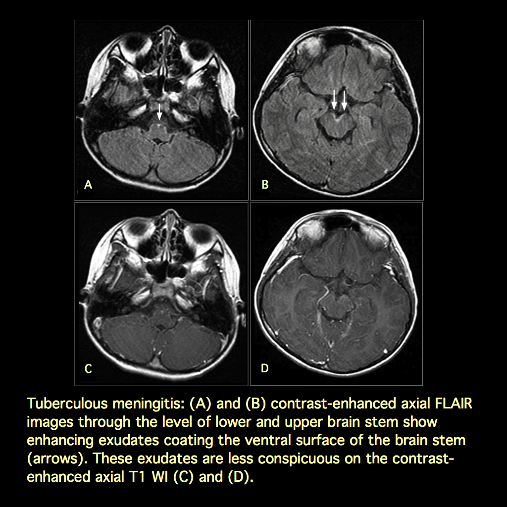 MRI BLOG: Contrast-enhanced FLAIR for Infectious Leptomeningitis