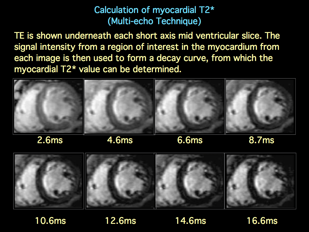 MRI BLOG: T2* Measurement of Myocardial Iron in Thalassemia (Part I)