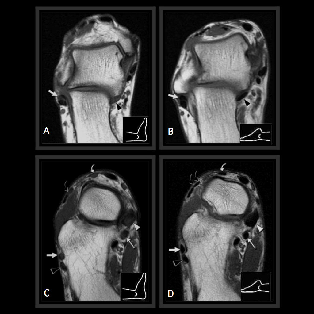 MRI BLOG: Magic Angle Phenomenon