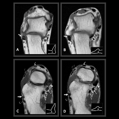 MRI BLOG: Magic Angle Phenomenon