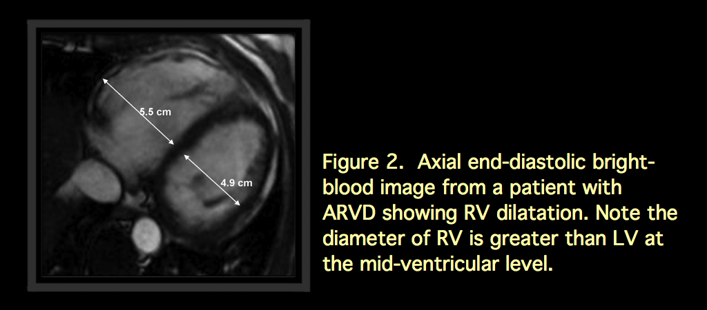 MRI BLOG: Arrhythmogenic Right Ventricular Dysplasia/Cardiomyopathy ...