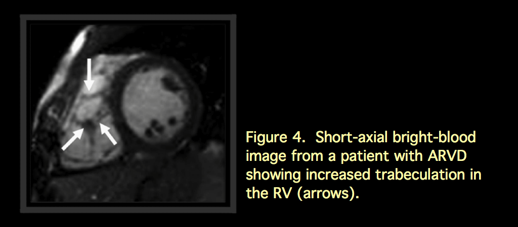 MRI BLOG: Arrhythmogenic Right Ventricular Dysplasia/Cardiomyopathy ...